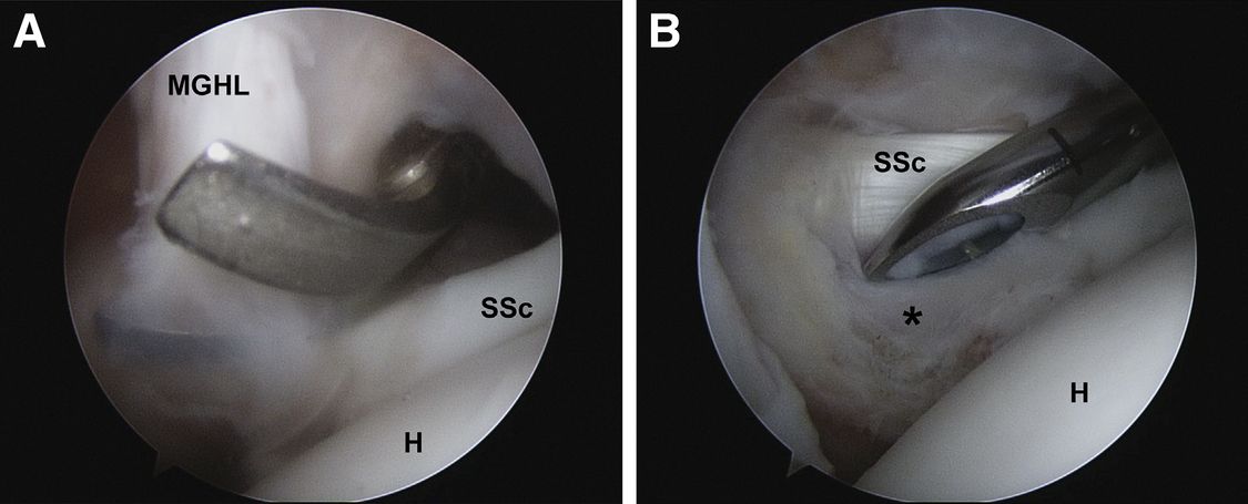 Subscapularis Tendon - WikiBeemed