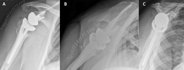Shoulder:Glenohumeral Arthritis/Reverse Shoulder Arthroplasty - WikiBeemed